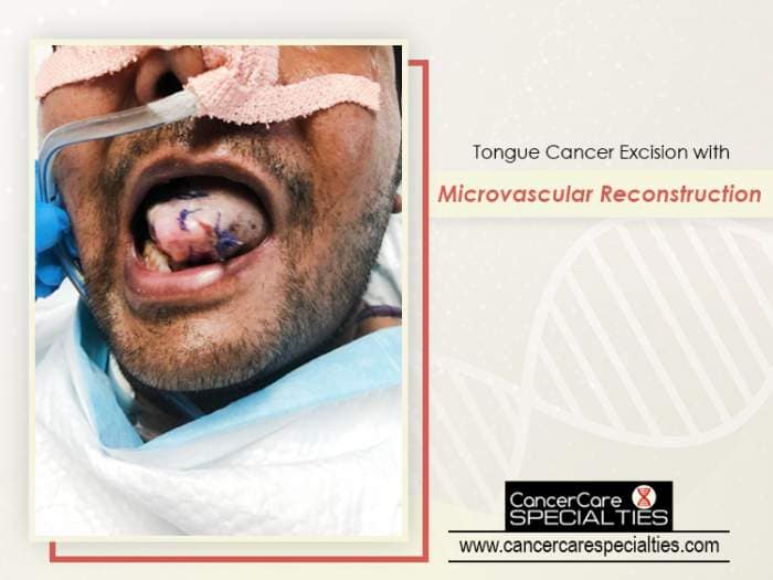 Tongue cancer excision with microvascular reconstruction. - Cancer Care ...